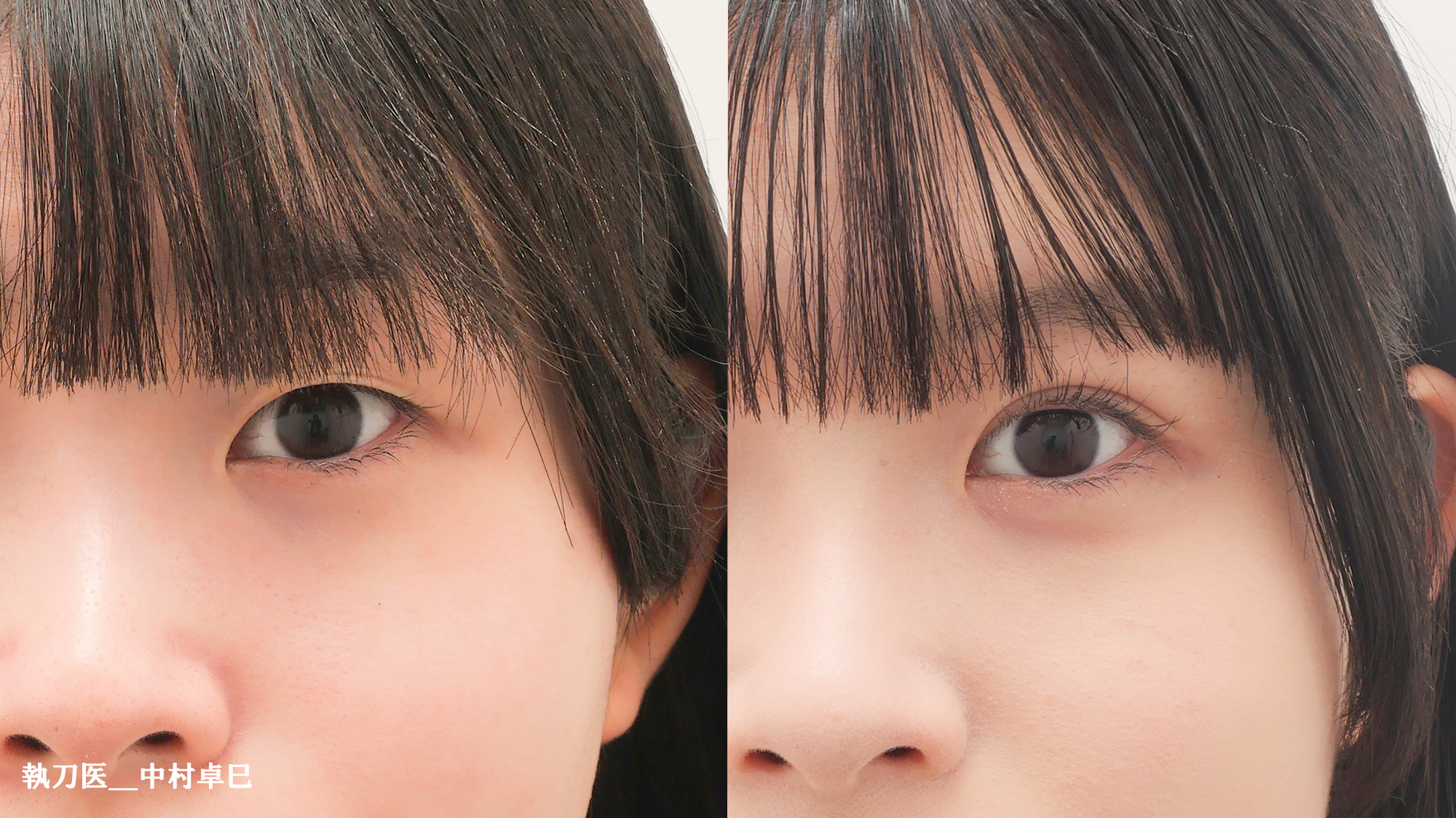 蒙古襞がないとどんな印象の目になる？印象の違いを写真で解説 埋没法・二重整形の基礎知識 東京イセアクリニック